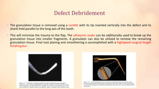 Minimally invasive surgical techniques in periodontics | PPTX