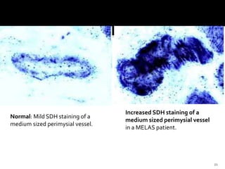 Mitochondial disorders | PPT