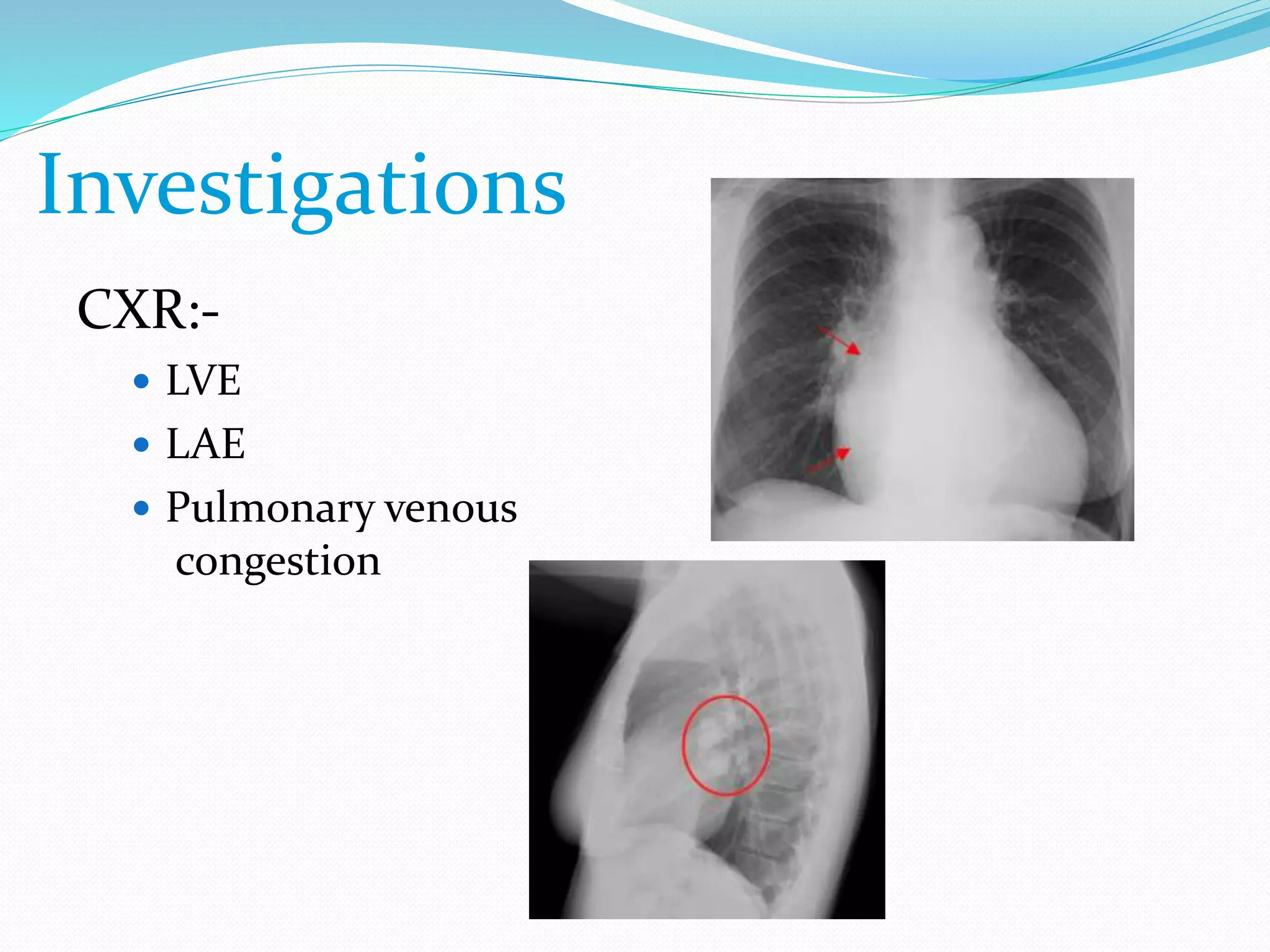 Mitral regurgitation | PPTX