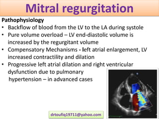Mitral regurgitation for post graduates | PPSX
