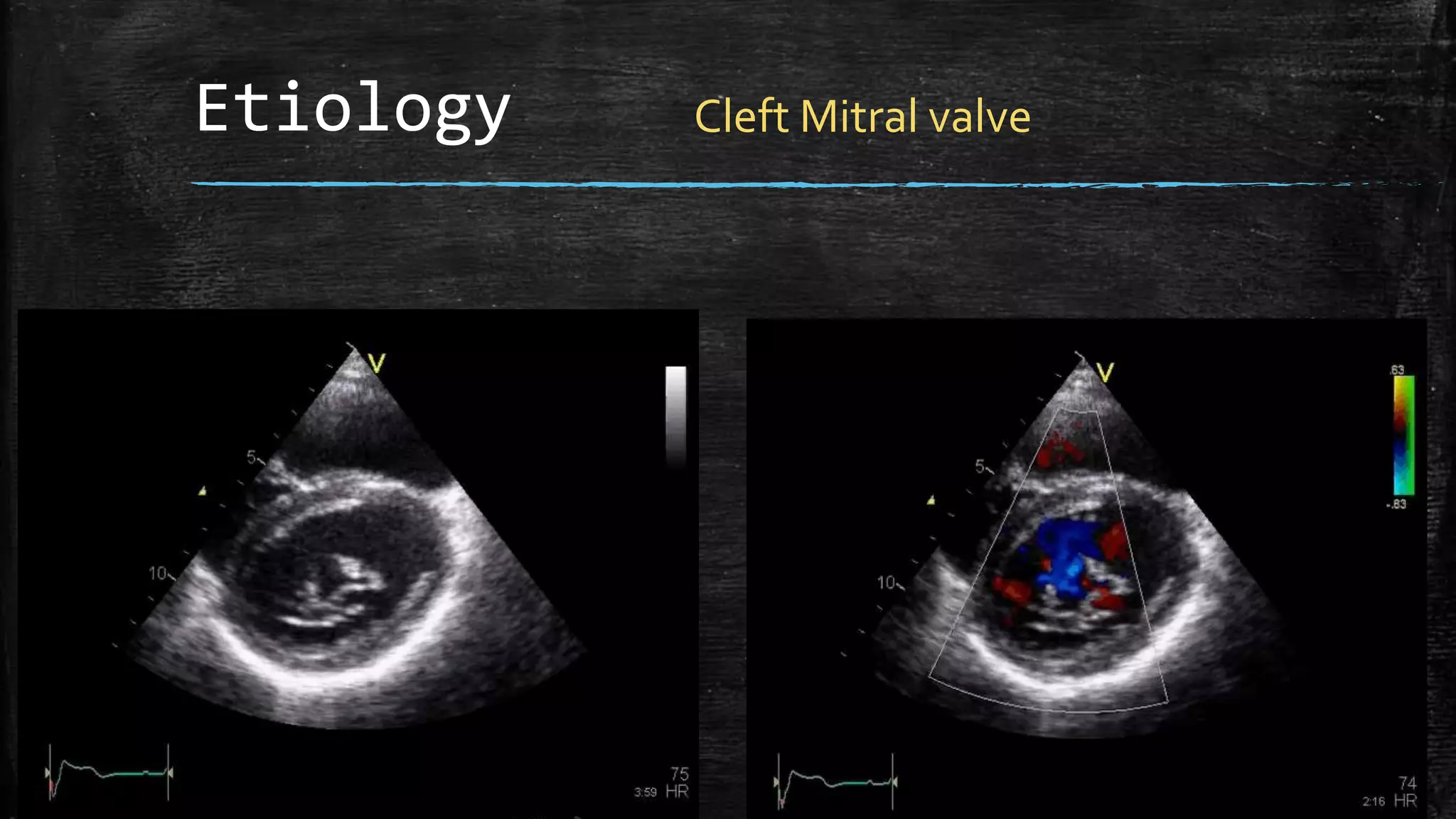 Echocardiography of Mitral regurgitation | PPTX