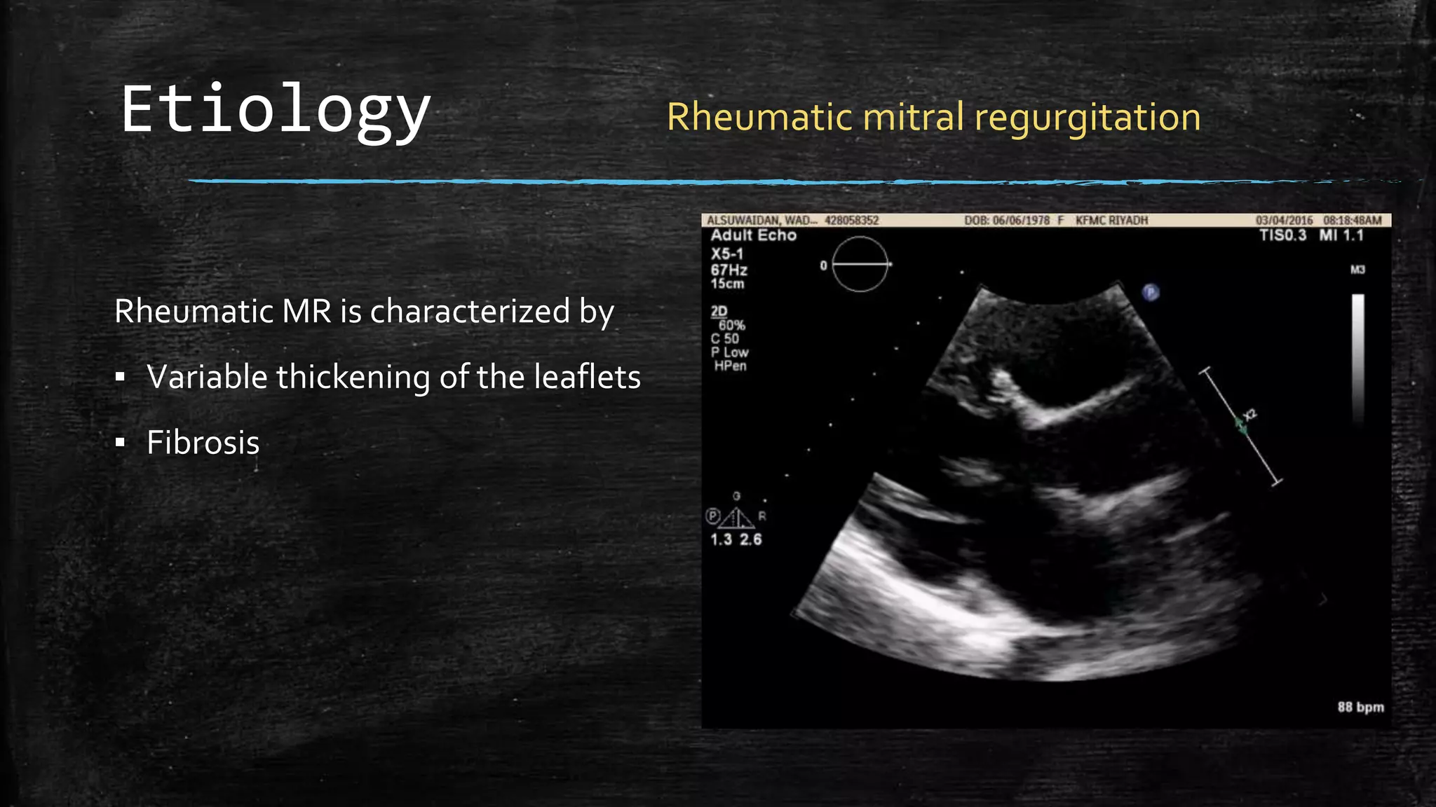 Echocardiography of Mitral regurgitation | PPTX