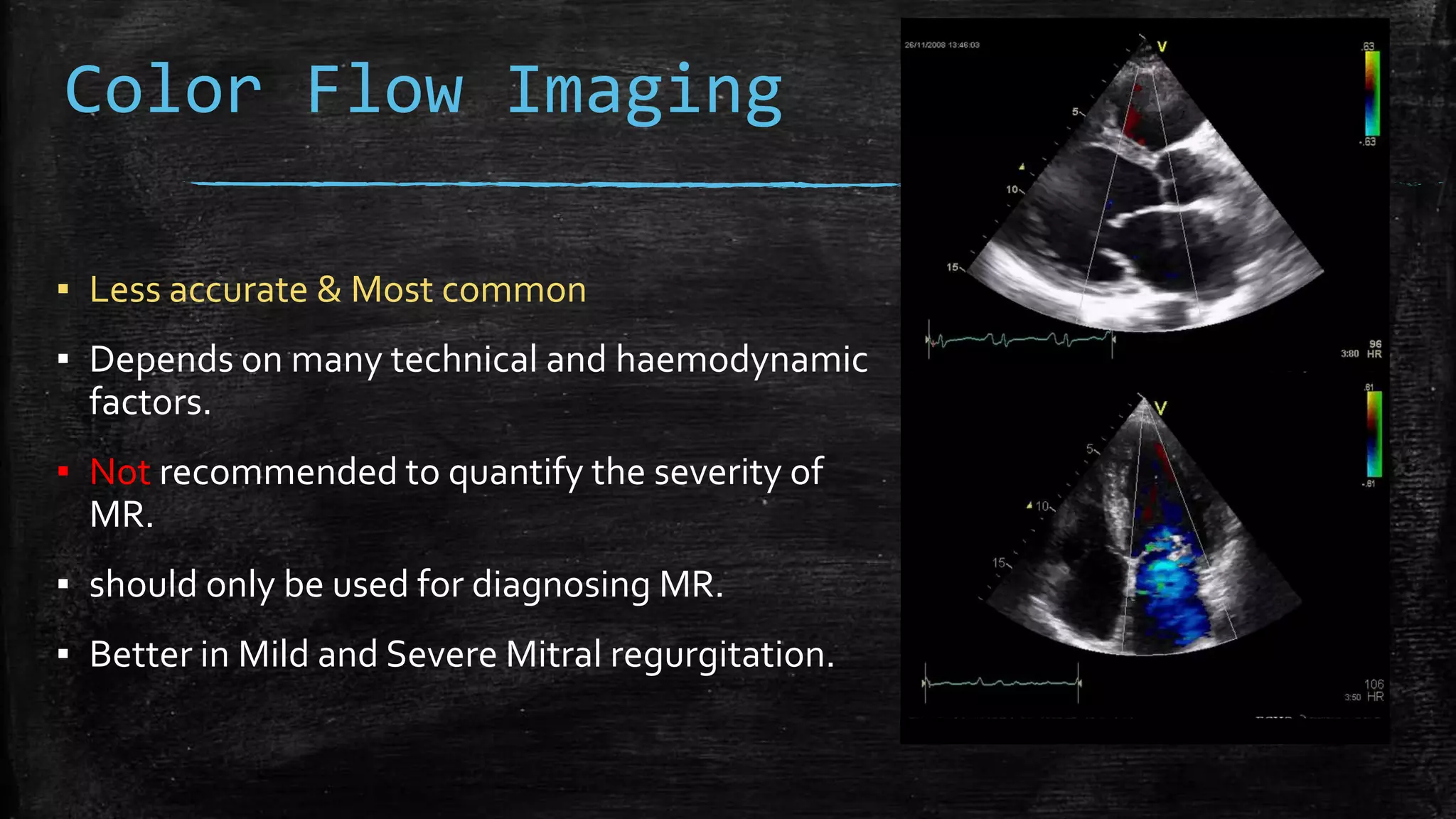 Echocardiography of Mitral regurgitation | PPTX
