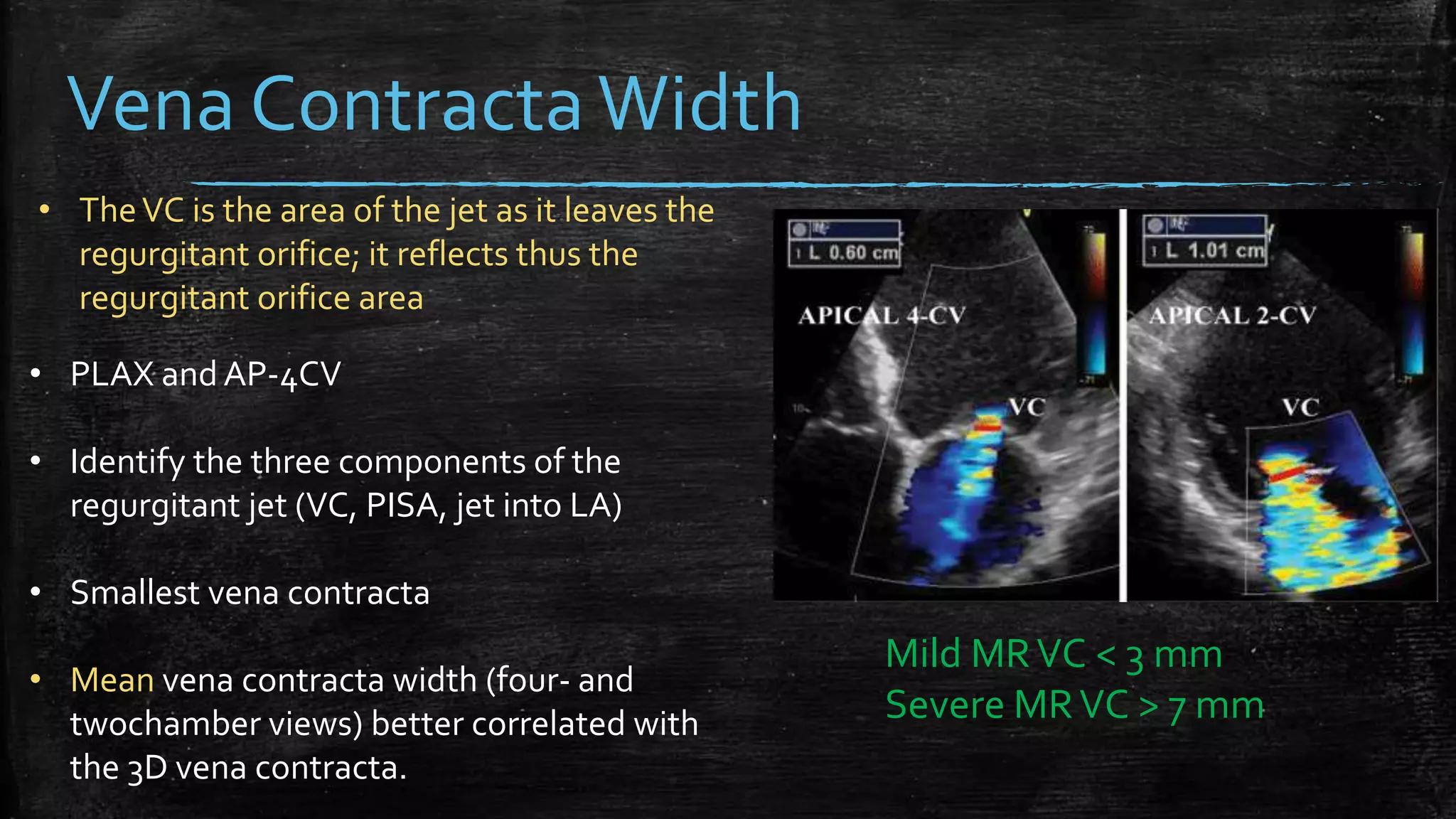 Echocardiography of Mitral regurgitation | PPTX