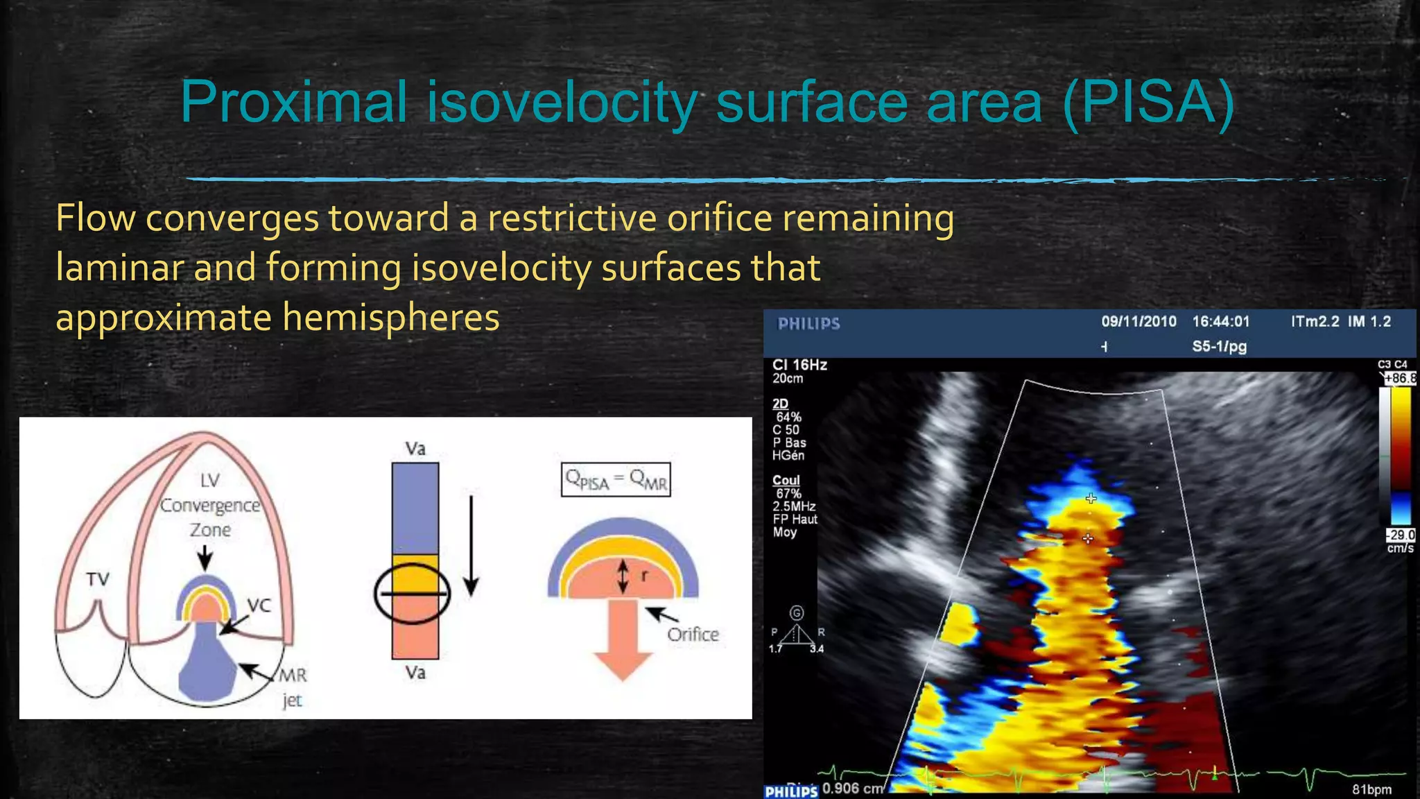 Echocardiography of Mitral regurgitation | PPTX