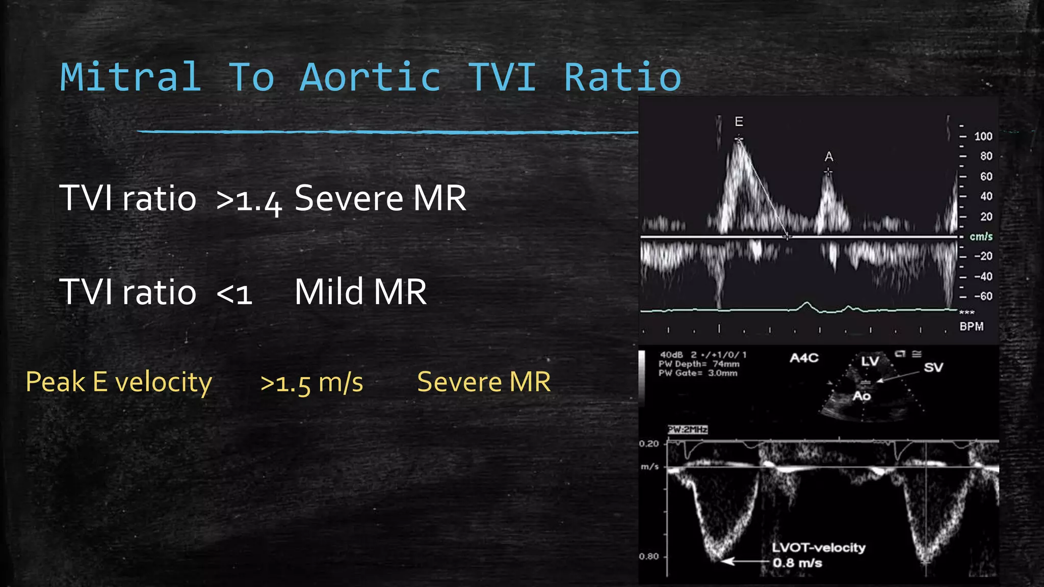 Echocardiography of Mitral regurgitation | PPTX