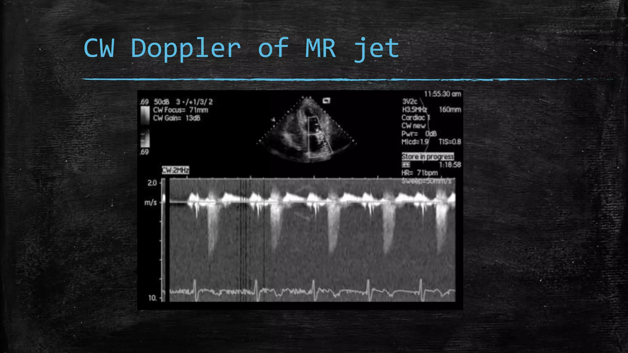 Echocardiography of Mitral regurgitation | PPTX