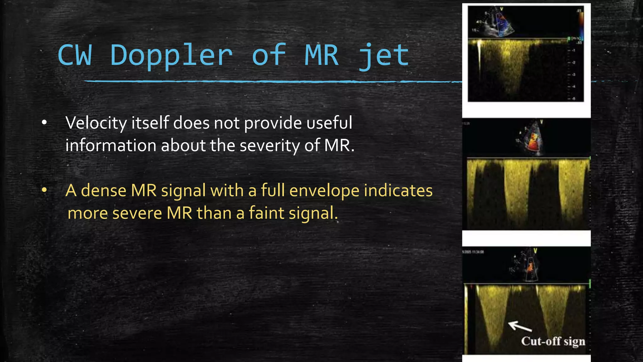 Echocardiography of Mitral regurgitation | PPTX