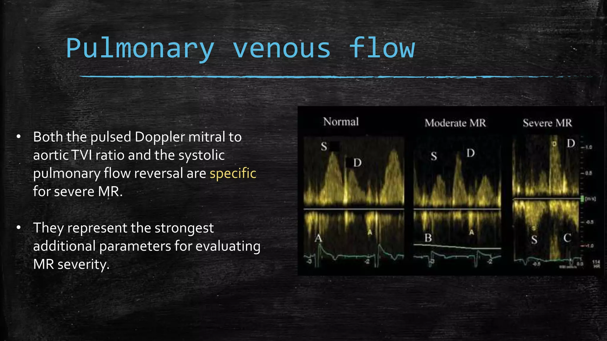 Echocardiography of Mitral regurgitation | PPTX