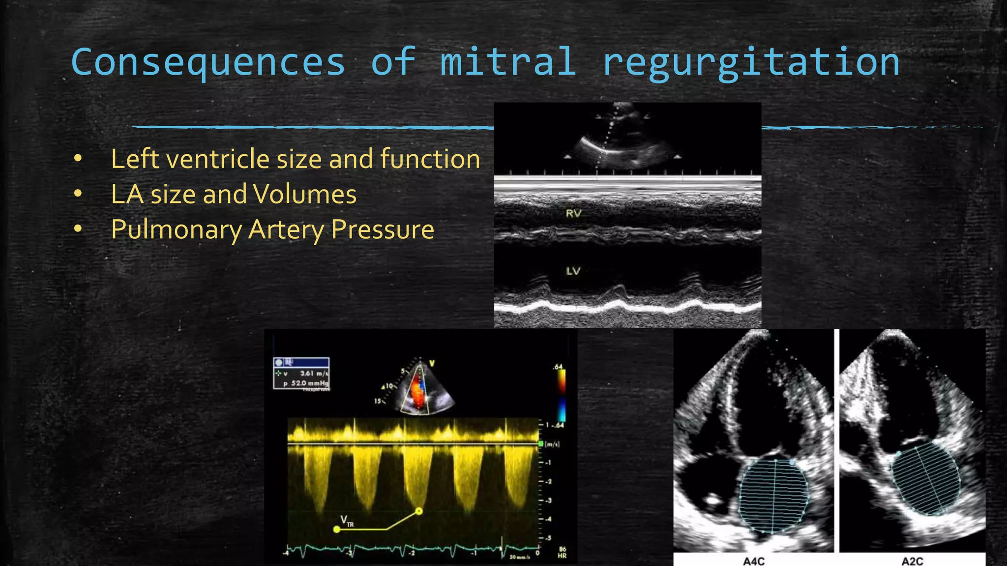 Echocardiography of Mitral regurgitation | PPTX