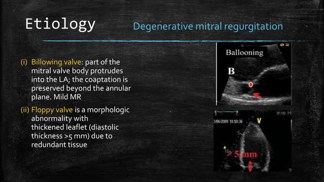Echocardiography of Mitral regurgitation | PPTX | Heart and Cardiovascular Diseases | Diseases ...
