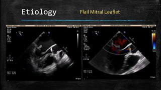 Echocardiography of Mitral regurgitation | PPTX