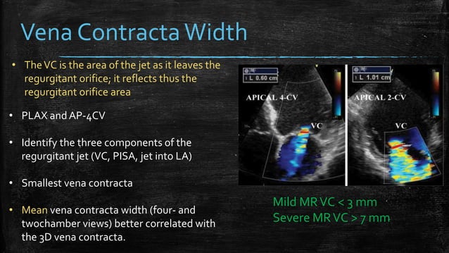 Echocardiography of Mitral regurgitation | PPT