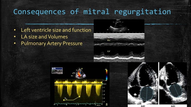 Echocardiography of Mitral regurgitation | PPTX | Heart and ...