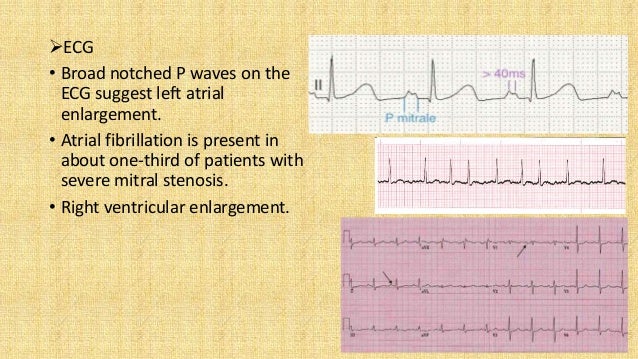 Mitral Stenosis and Anaesthetic Management