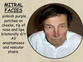 Mitral stenosis | PPTX