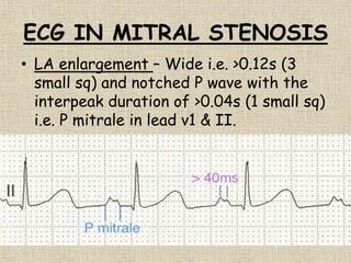 Mitral stenosis | PPTX