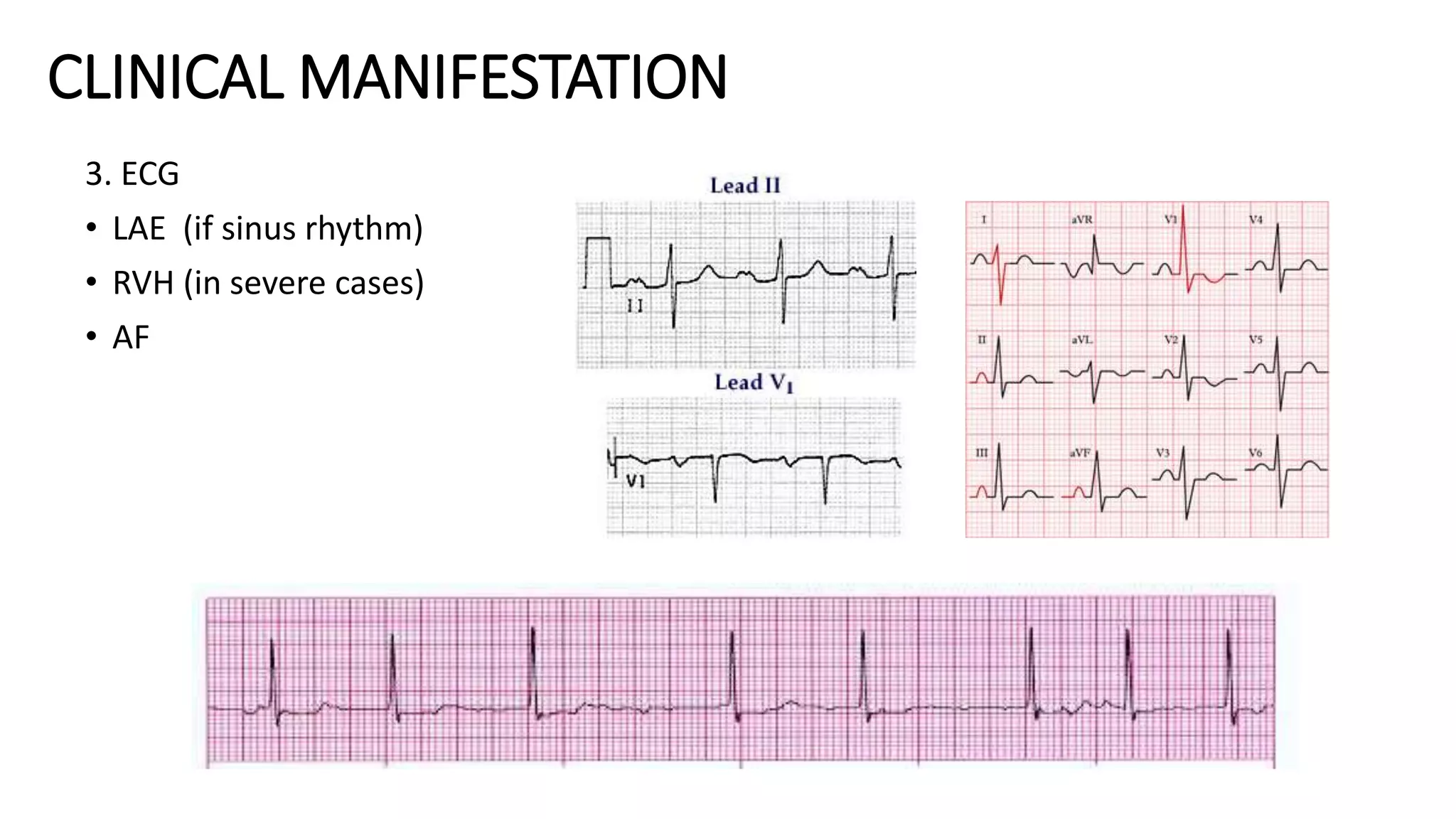 Mitral stenosis Clinical manifestation & echocardiography assessment | PPTX