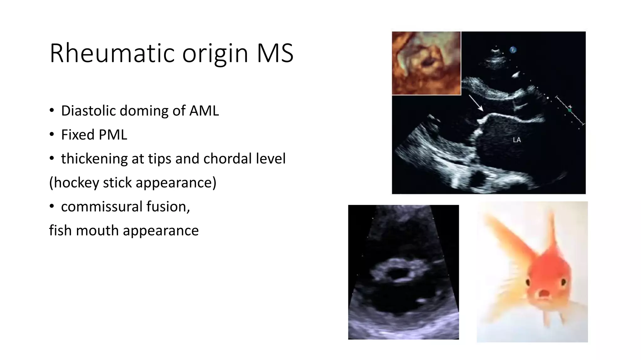 Mitral stenosis Clinical manifestation & echocardiography assessment | PPTX