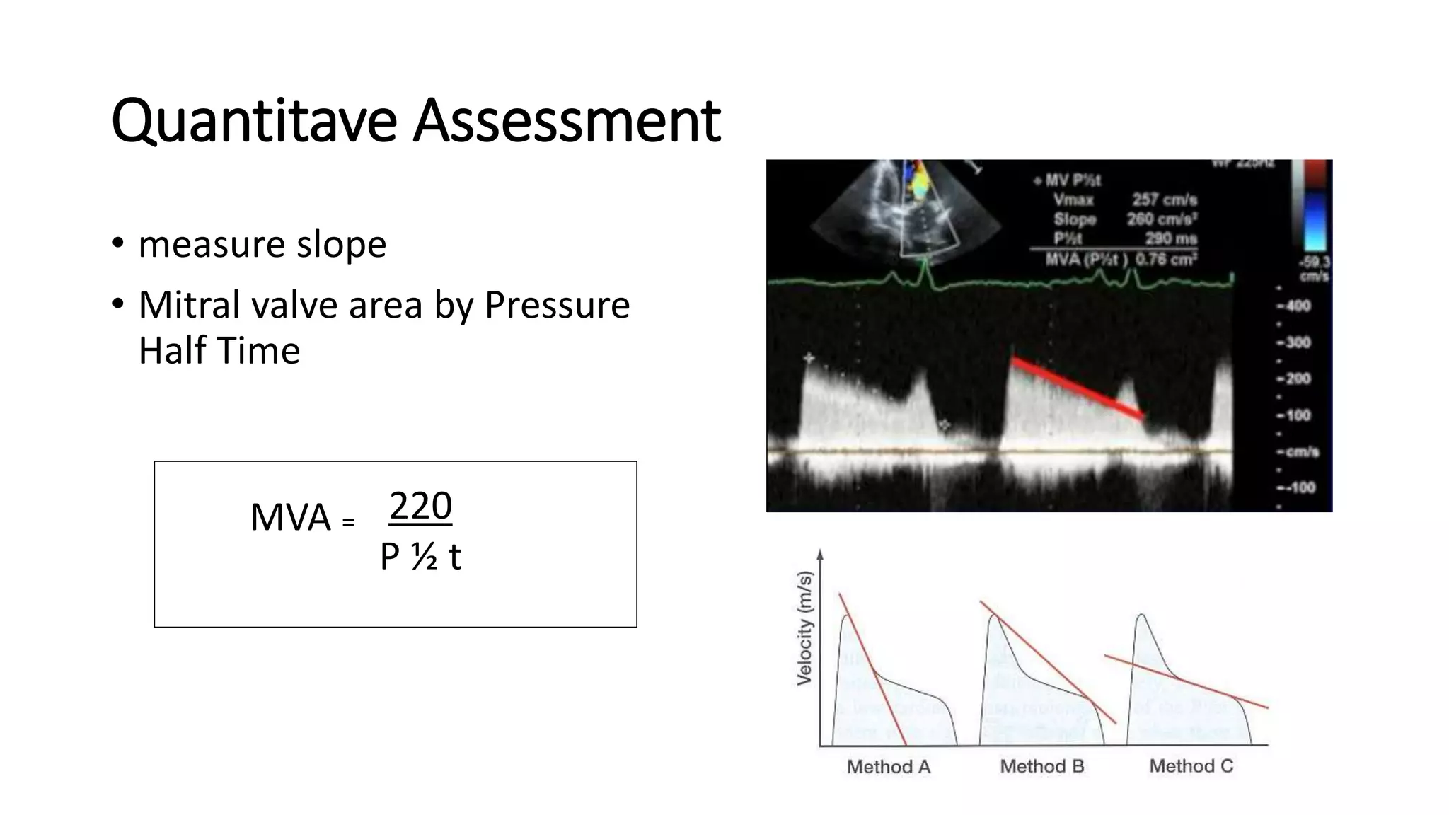 Mitral stenosis Clinical manifestation & echocardiography assessment | PPTX