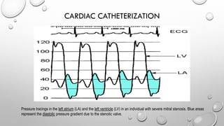 Mitral stenosis.pdf