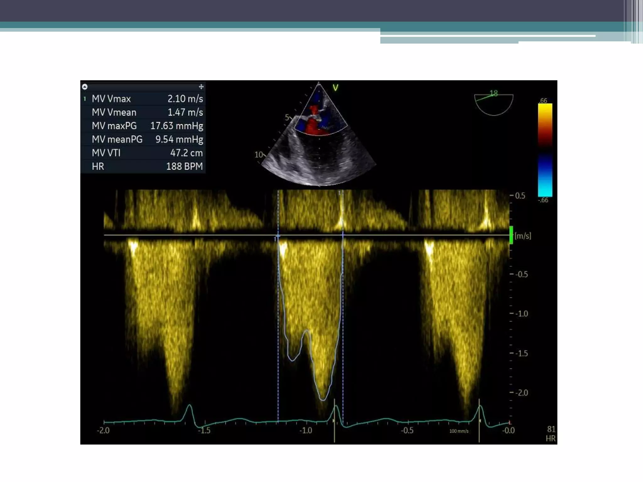 Mitral stenosis.pptx