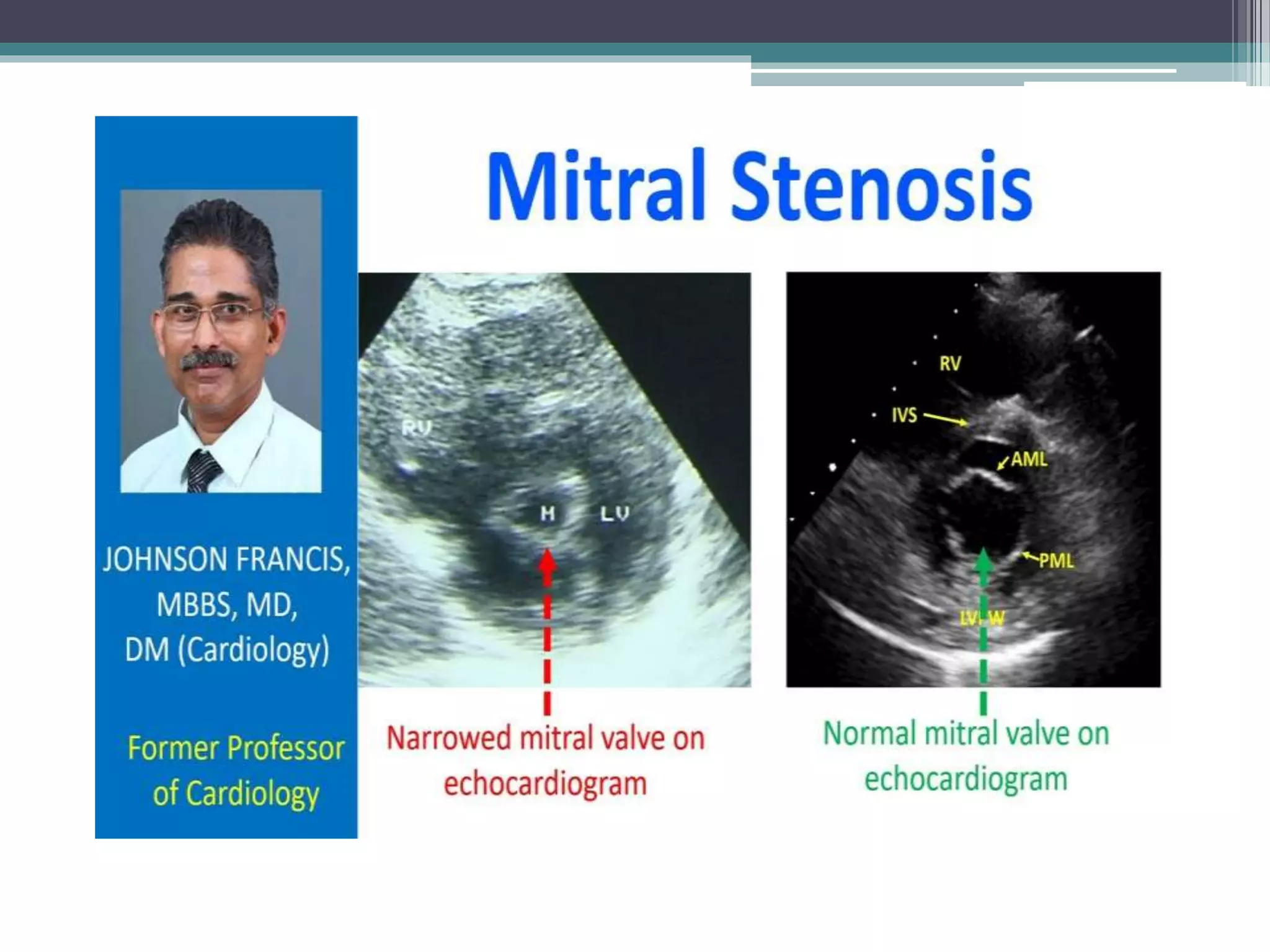 Mitral stenosis.pptx