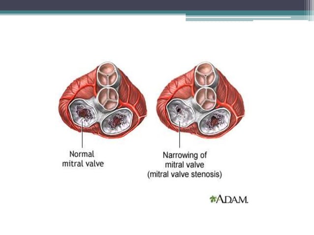 Mitral stenosis.pptx