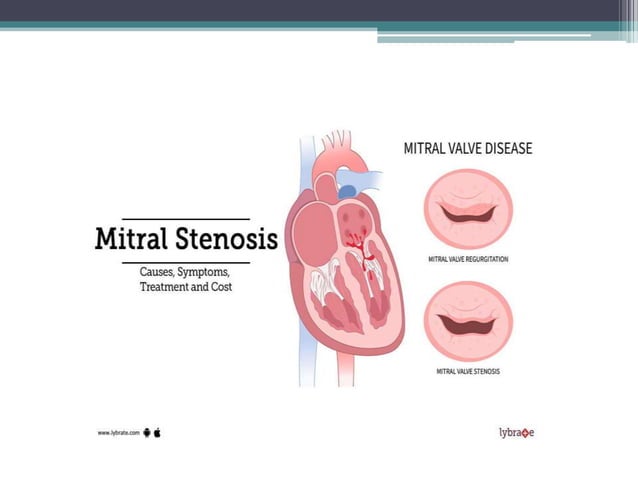 Mitral stenosis.pptx