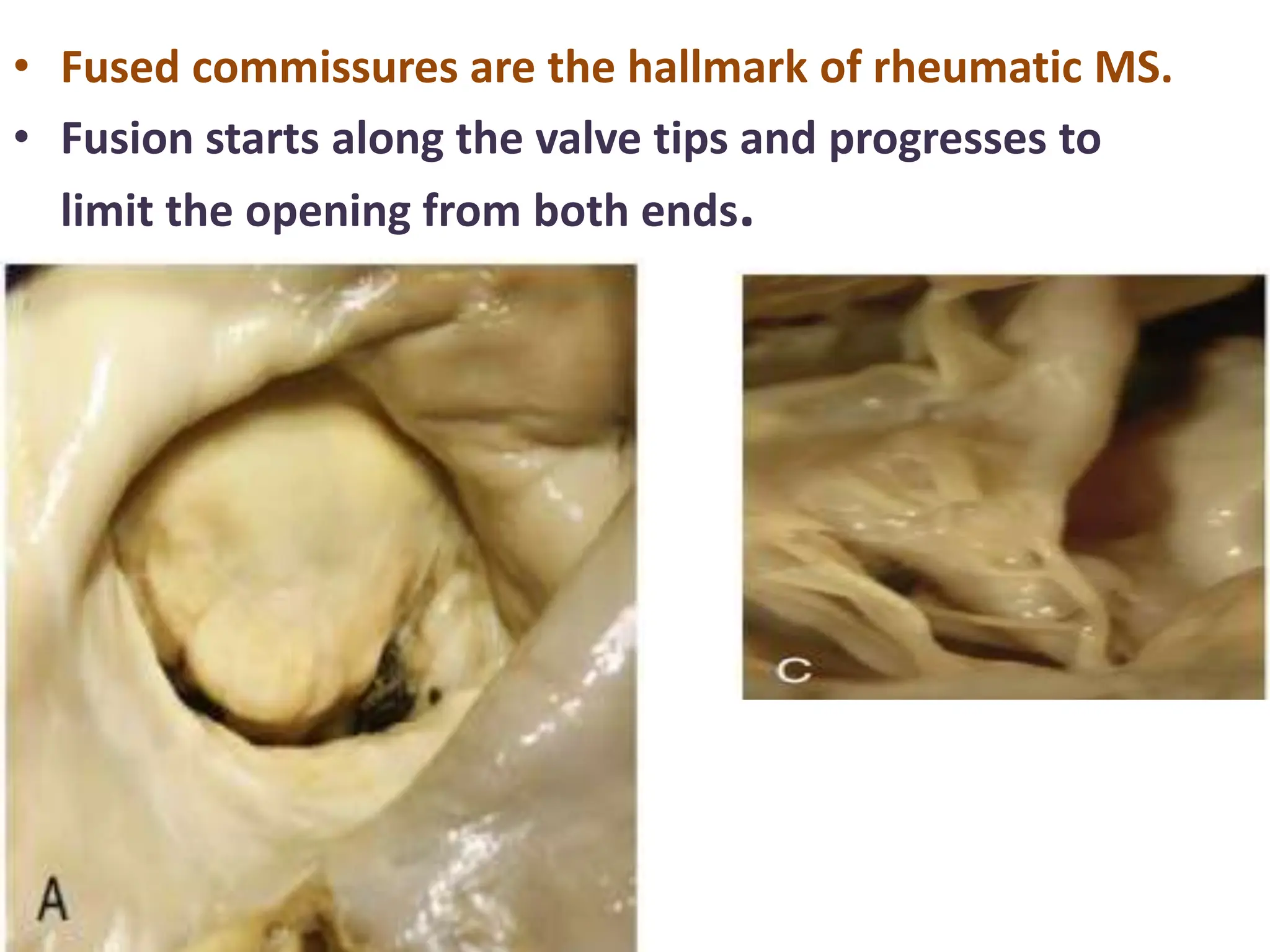 MITRAL STENOSIS - UG Final by Dr JTR.pptx