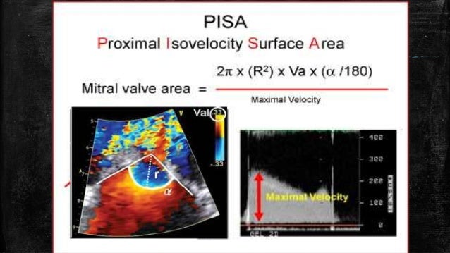 Echocardiography Mitral stenosis