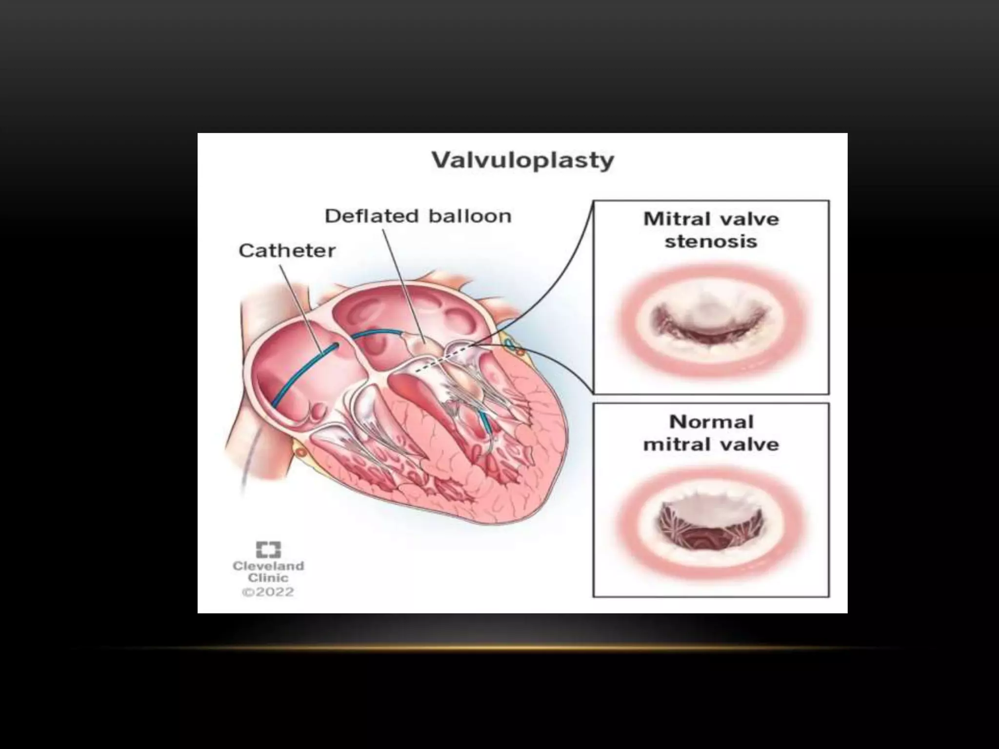 MITRAL STENOSIS PATHOLOGY.pptx