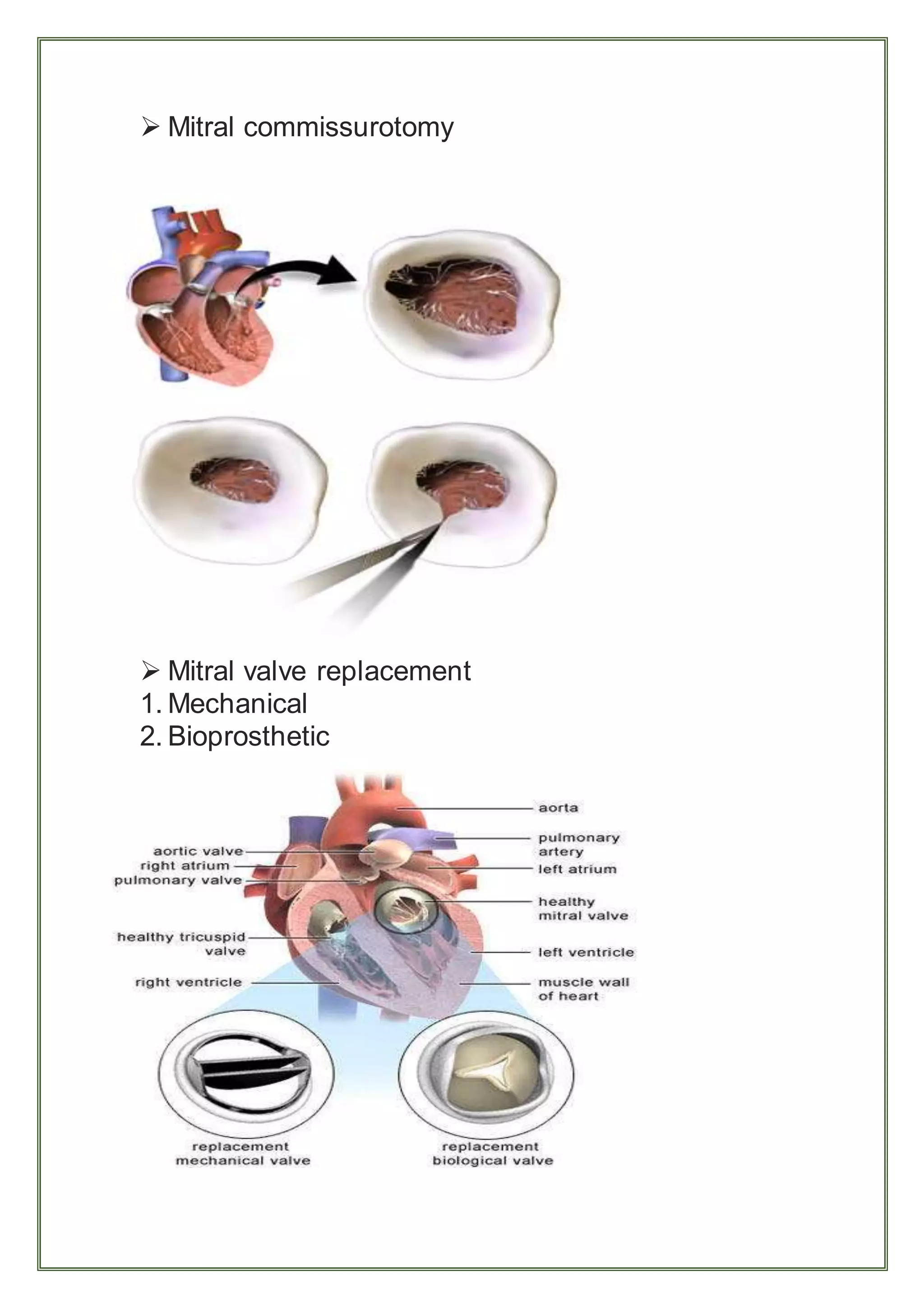 Mitral stenosis (propeduetics) | DOCX