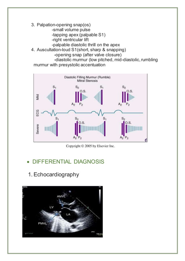 Mitral Stenosis Propeduetics