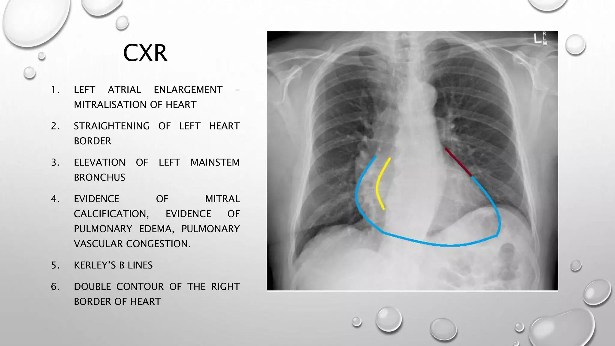 Mitral stenosis with pregnancy | PPTX