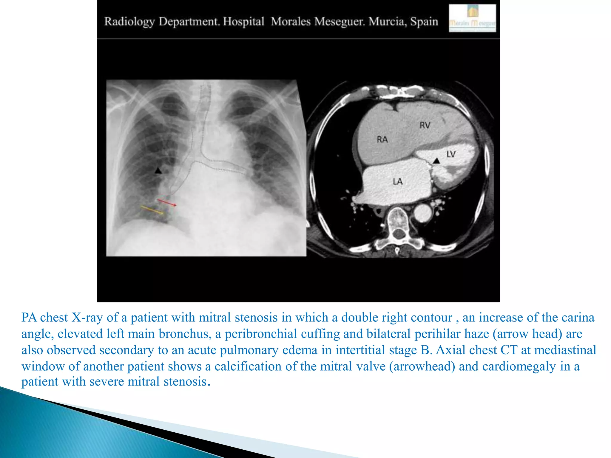 Mitral valve disease | PPTX