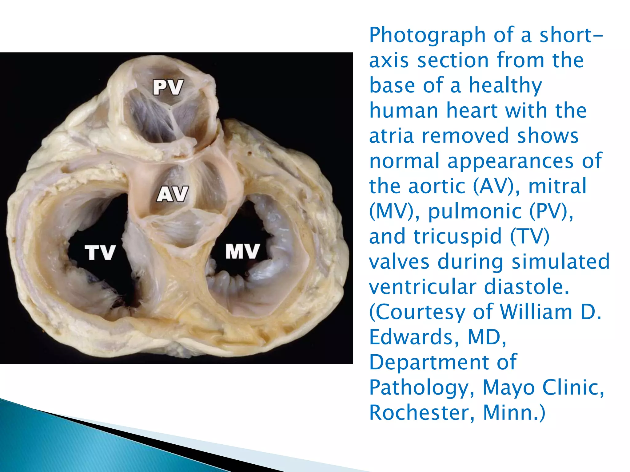 Mitral valve disease | PPTX