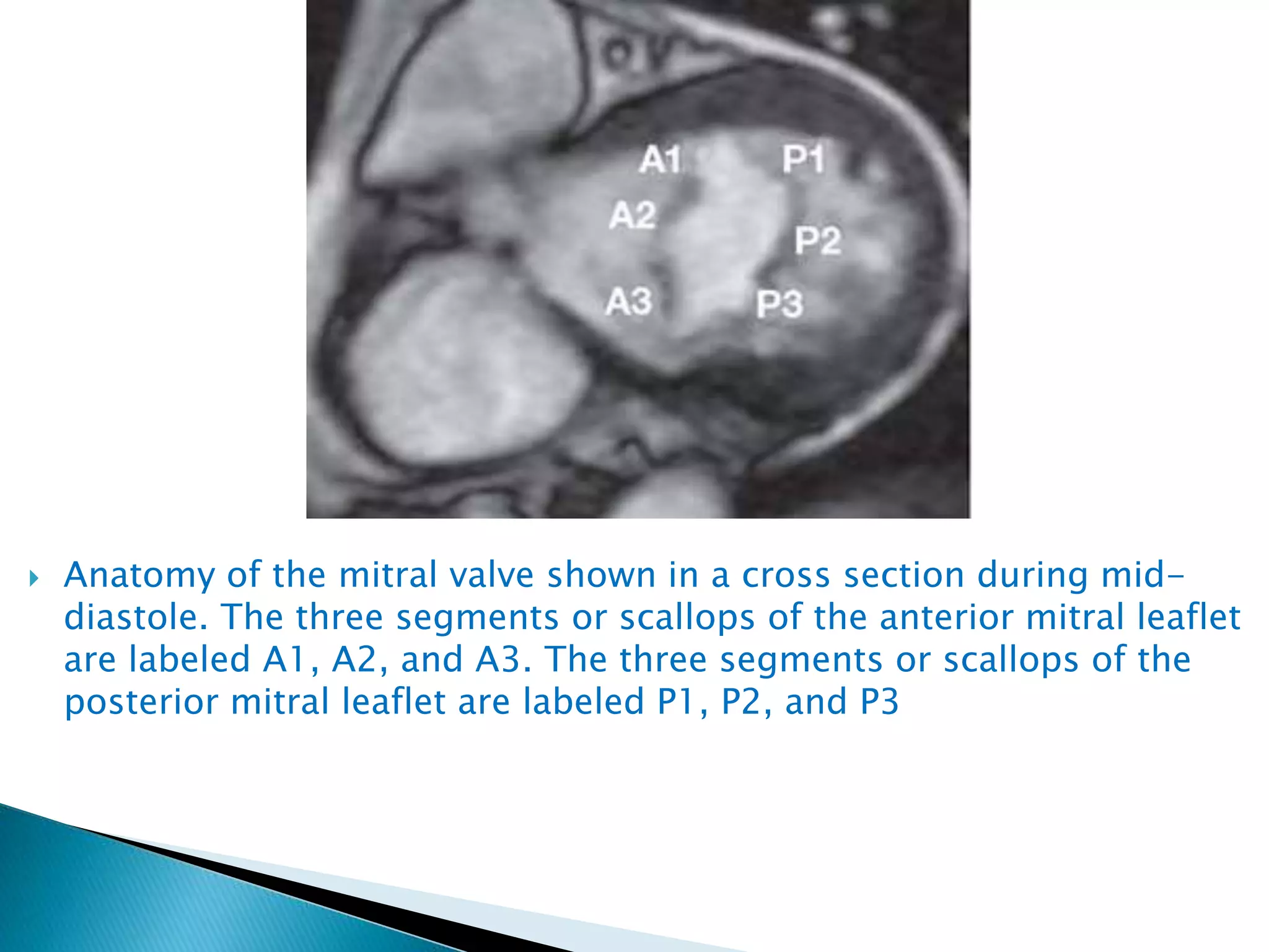 Mitral valve disease | PPTX