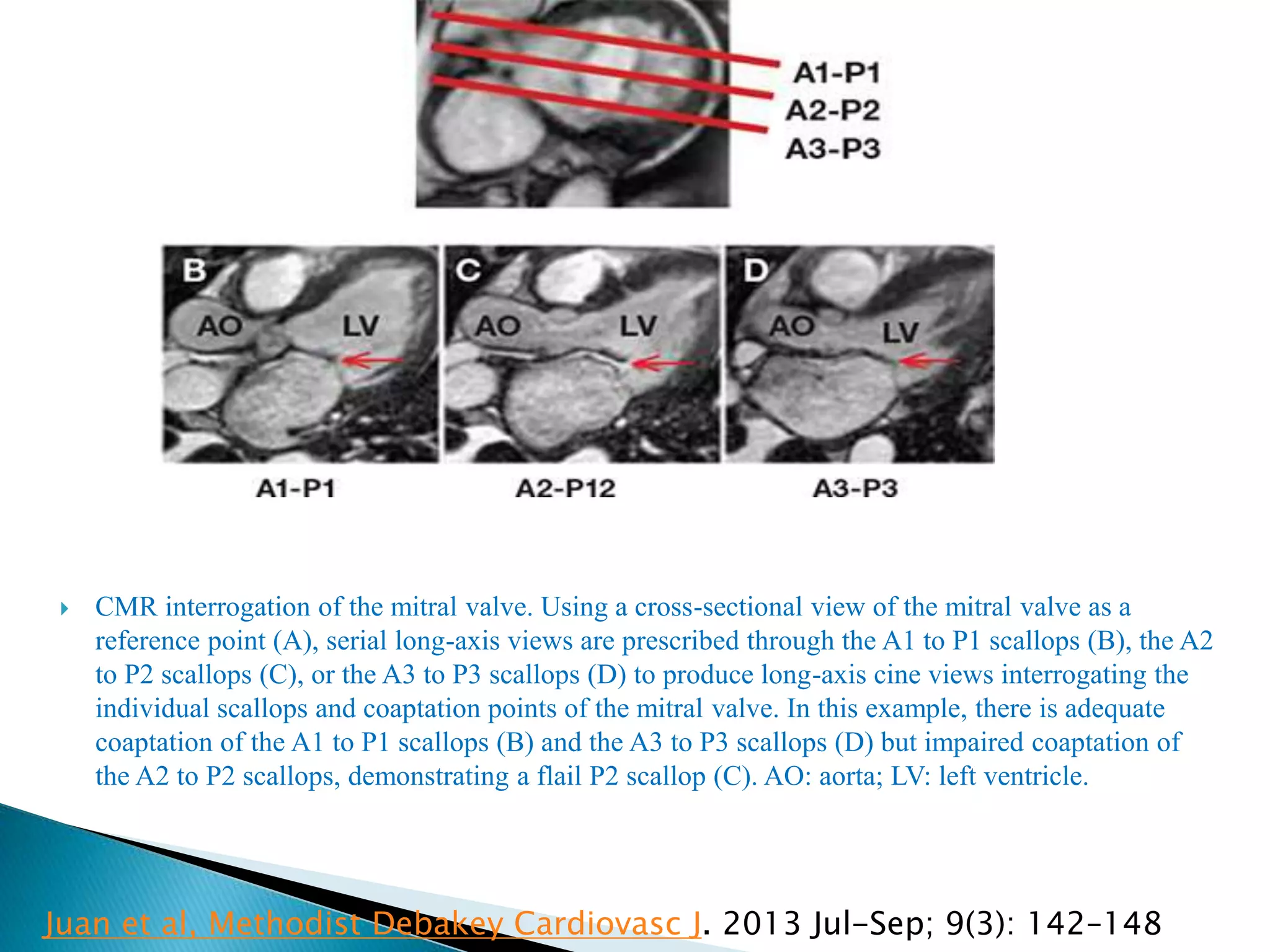 Mitral valve disease | PPTX