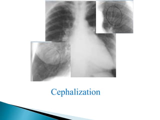 Mitral valve disease | PPTX