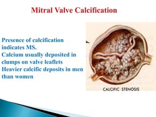 Mitral valve disease | PPTX