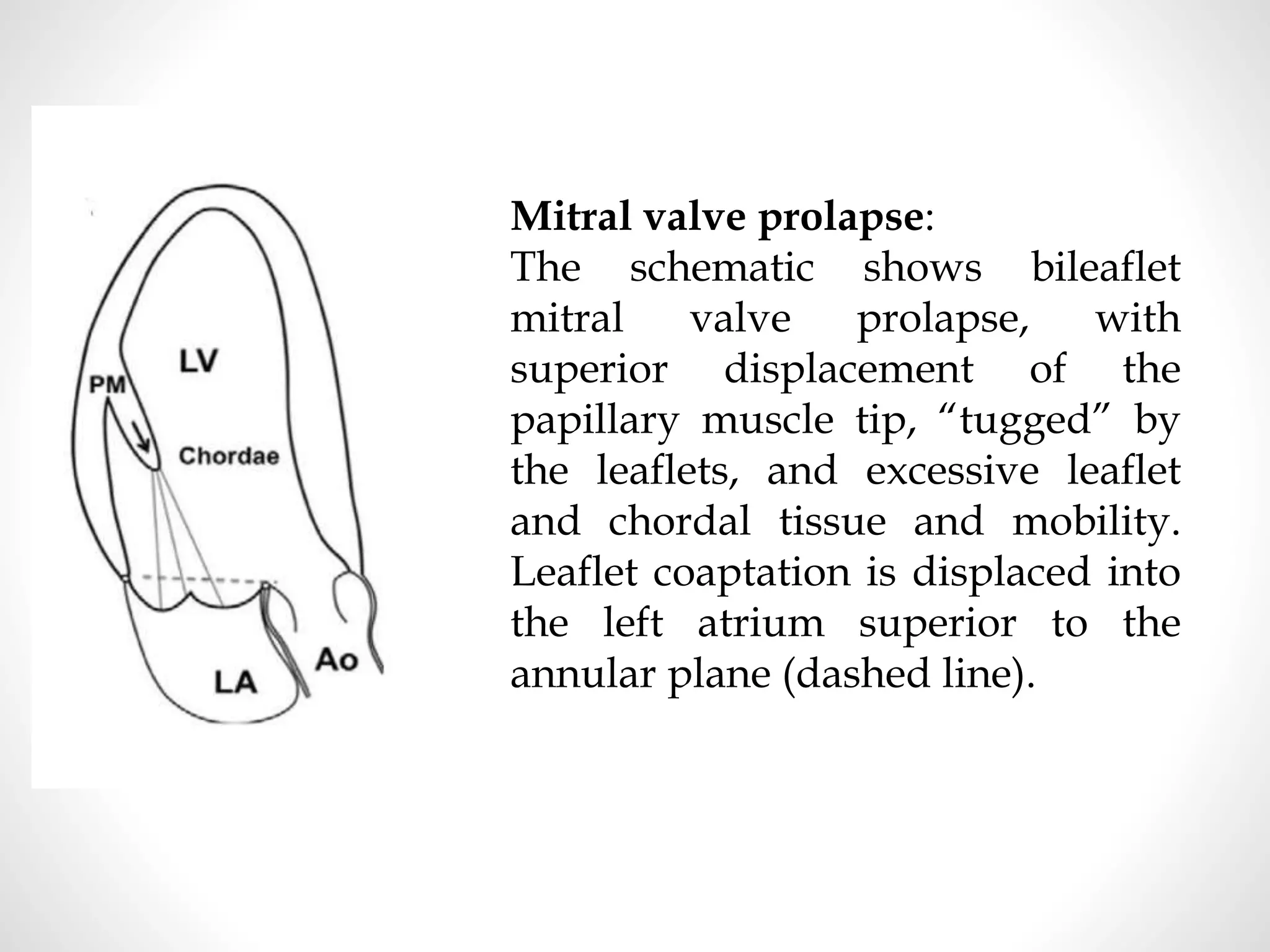Mitral valve anatomy.pptx | Heart and Cardiovascular Diseases ...