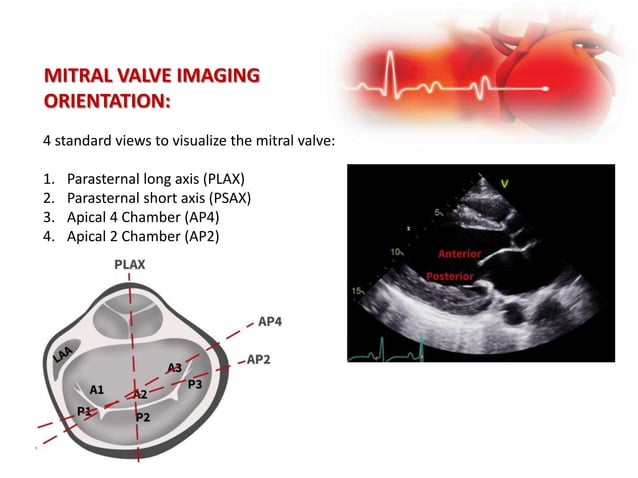 MITRAL VALVE ASSESSMENT ECHO 11.04.24.pptx | Heart and Cardiovascular ...