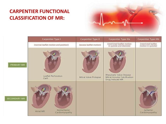 MITRAL VALVE ASSESSMENT ECHO 11.04.24.pptx | Heart and Cardiovascular ...