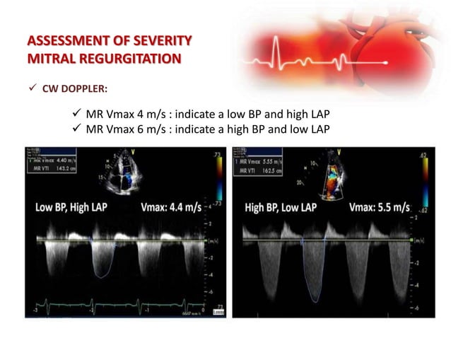 MITRAL VALVE ASSESSMENT ECHO 11.04.24.pptx | Heart and Cardiovascular ...