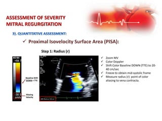 MITRAL VALVE ASSESSMENT ECHO 11.04.24.pptx | Heart and Cardiovascular Diseases | Diseases and ...