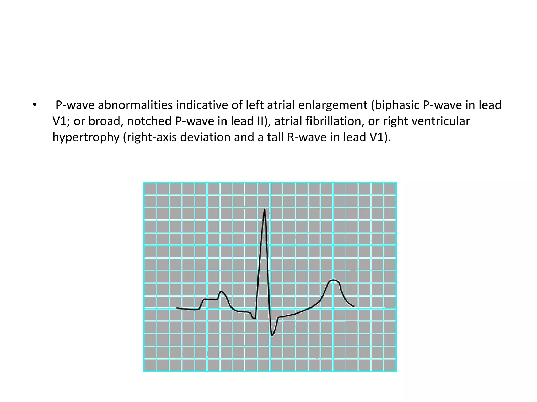 Mitral valve disease | PPTX