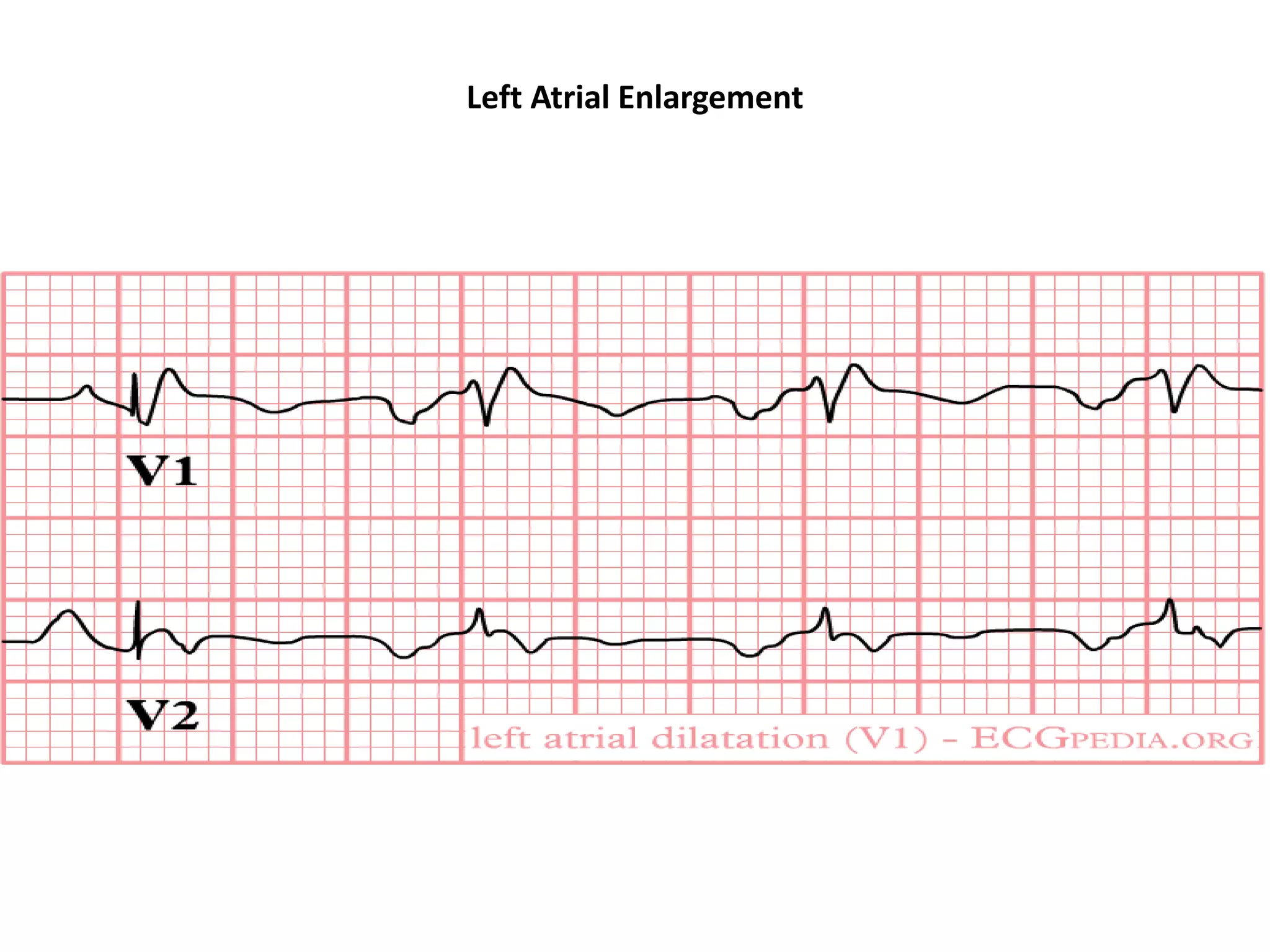 Mitral valve disease | PPTX