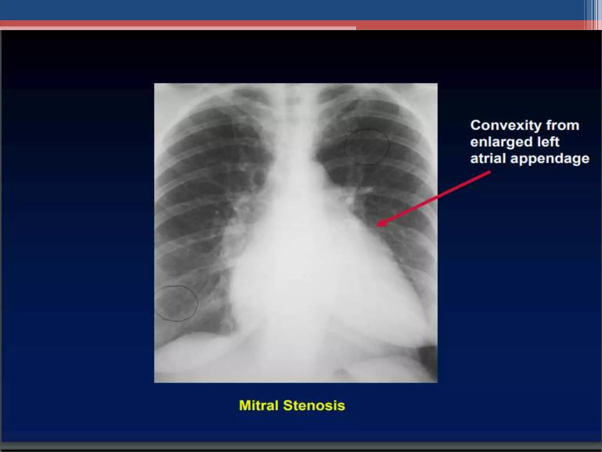 Mitral valve disease 2020 | PPT