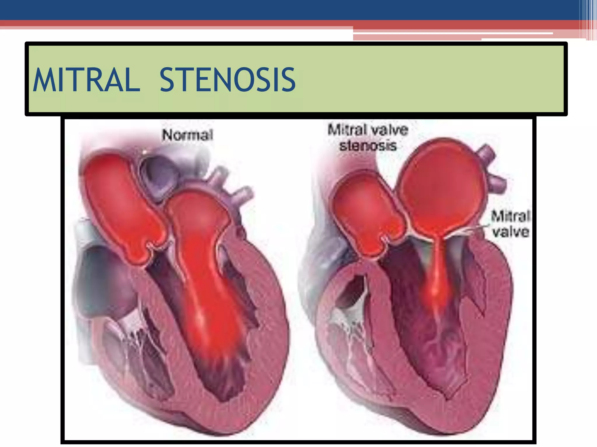 Mitral valve disease 2020 | PPT